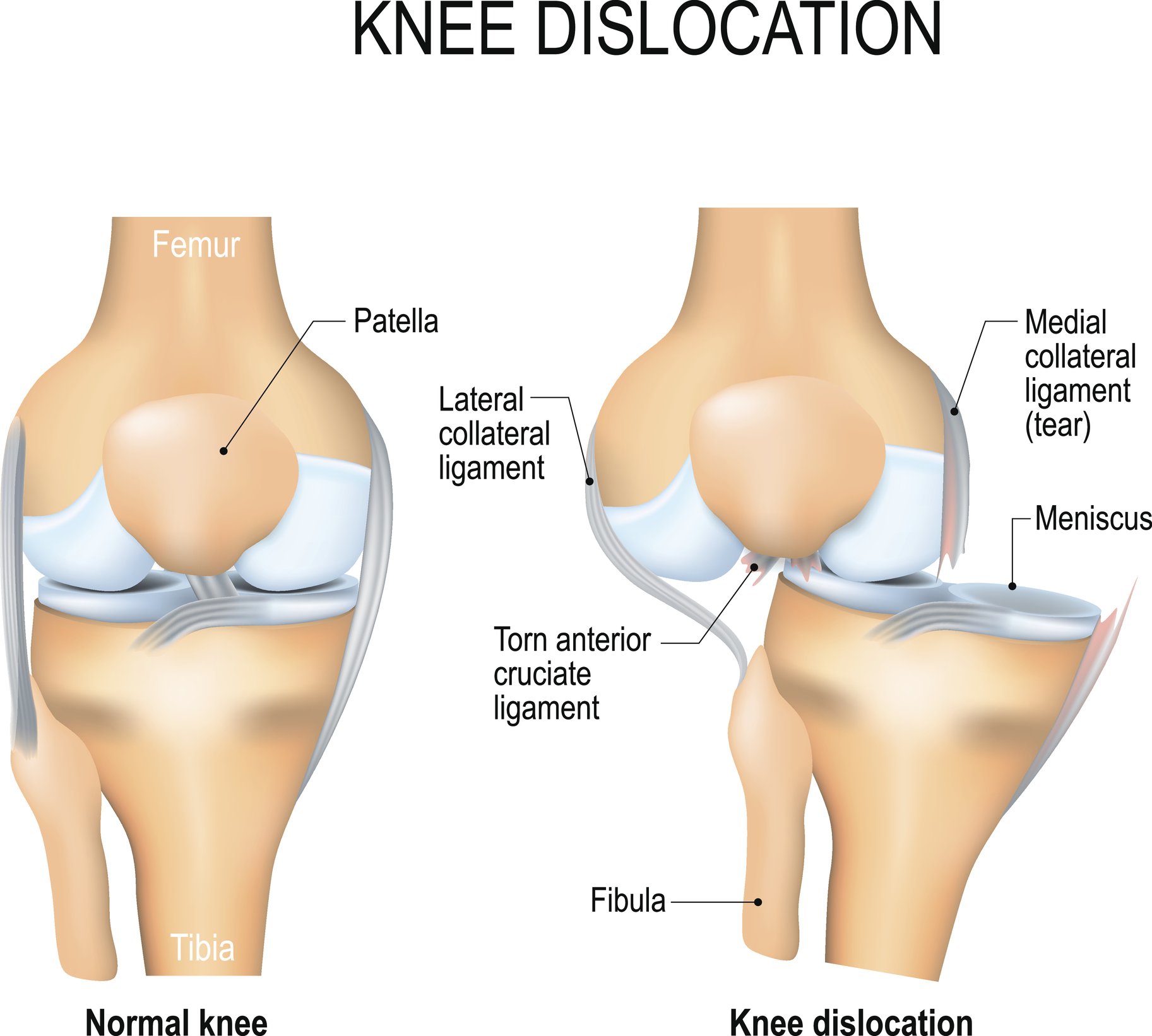Medial Meniscus Tear